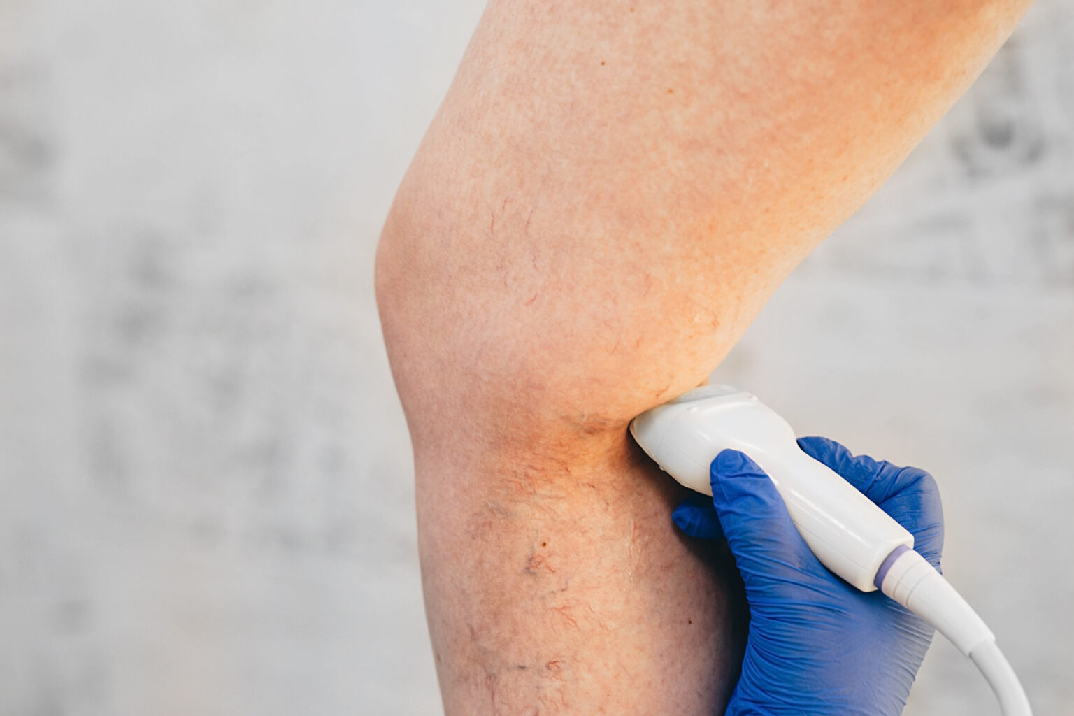 Understanding Vein Mapping: A Key - Susan Biegel MD